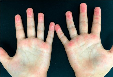 Dermatitis palmar - Demax Clinic